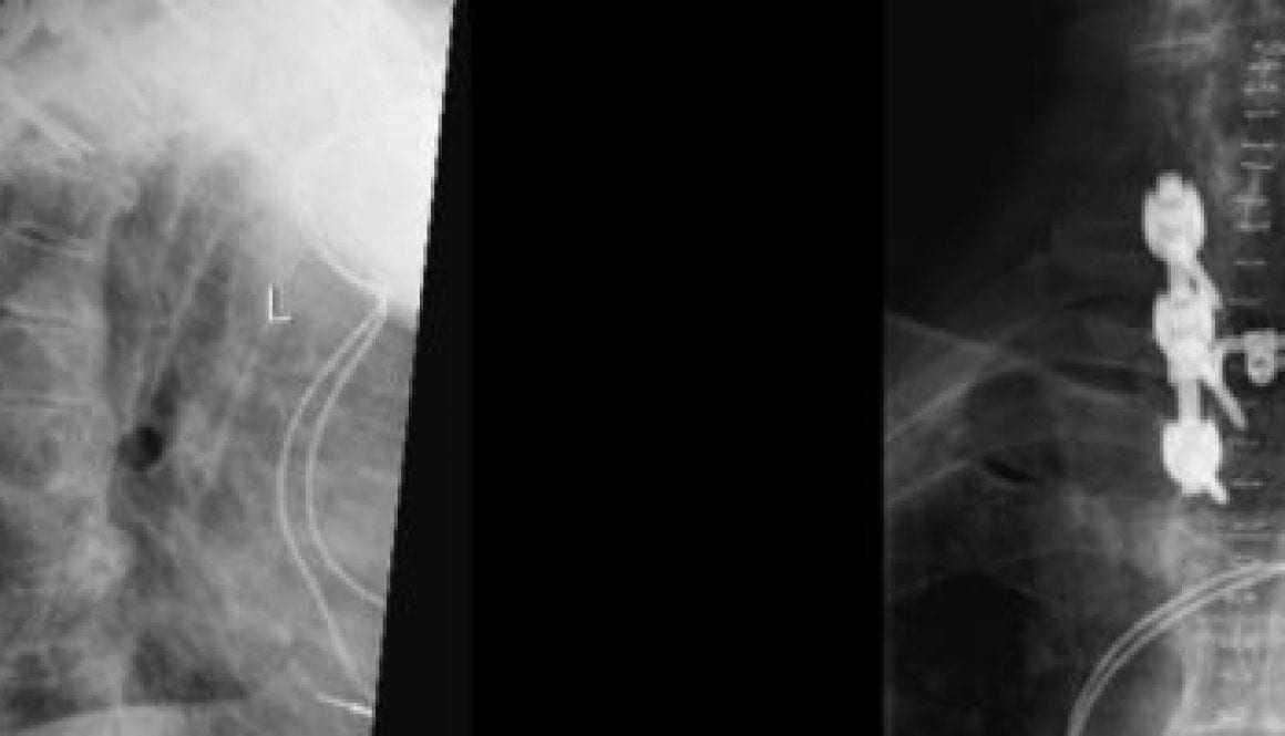 Keyhole Surgery Archives - Sunshine Coast Neurosurgery