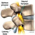 Lumbar Spine Surgery – Sunshine Coast Neurosurgery