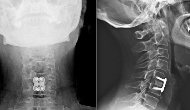 Cervical Spine Surgery Sunshine Coast Neurosurgery